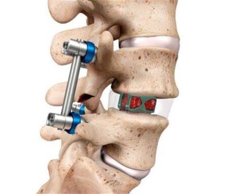 Lumbar Interbody Fusion | SpineDRX