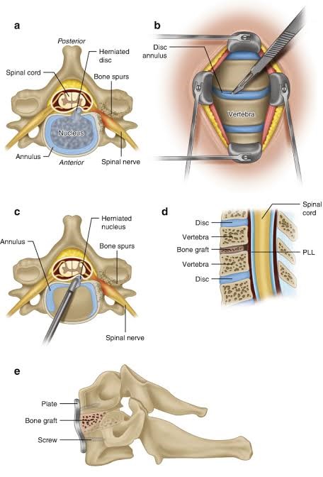 Anterior Cervical Discectomy & Fusion | SpineDRX