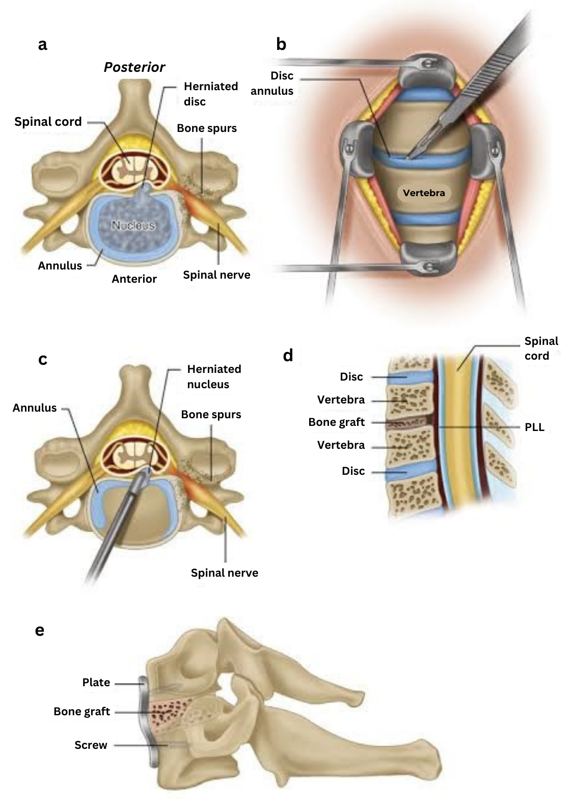 Anterior Cervical Discectomy Fusion SpineDRX Anterior Cervical Discectomy Fusion SpineDRX